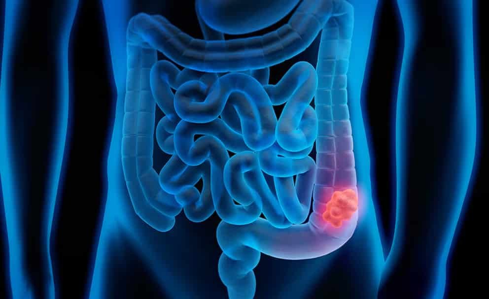 El cáncer colorrectal se convierte en la principal causa de muerte ...
